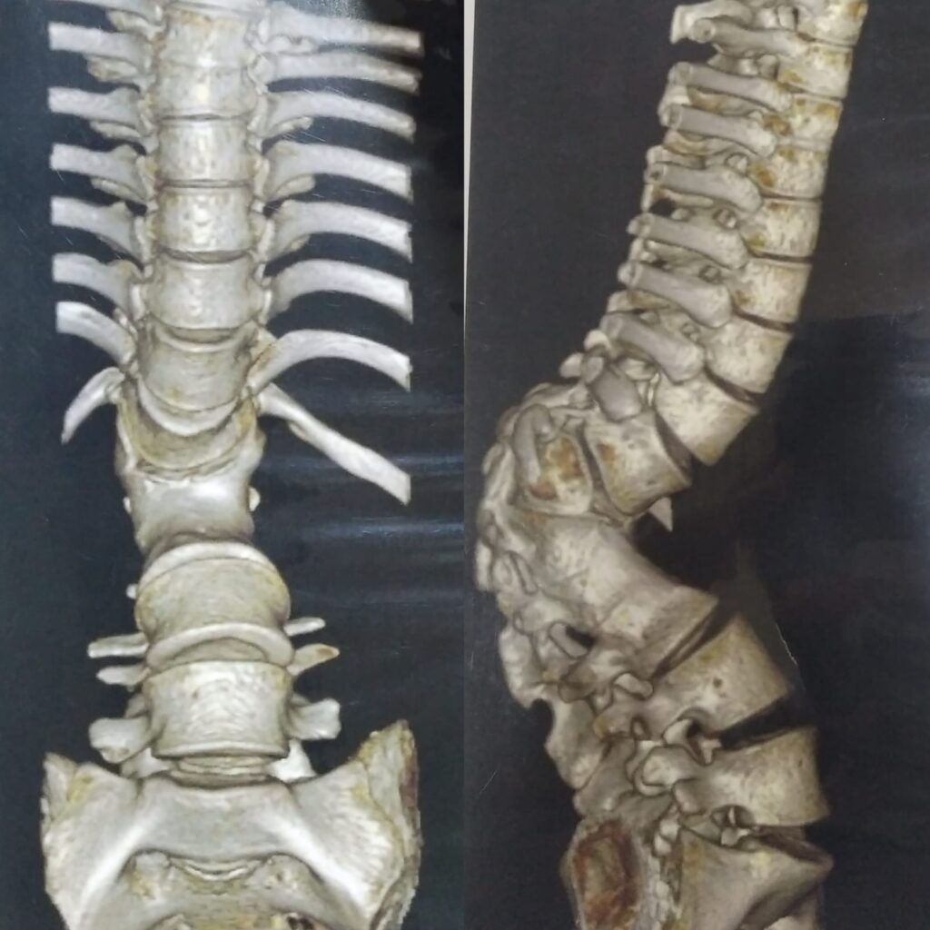 Case Study: Correcting Congenital Spine Deformity