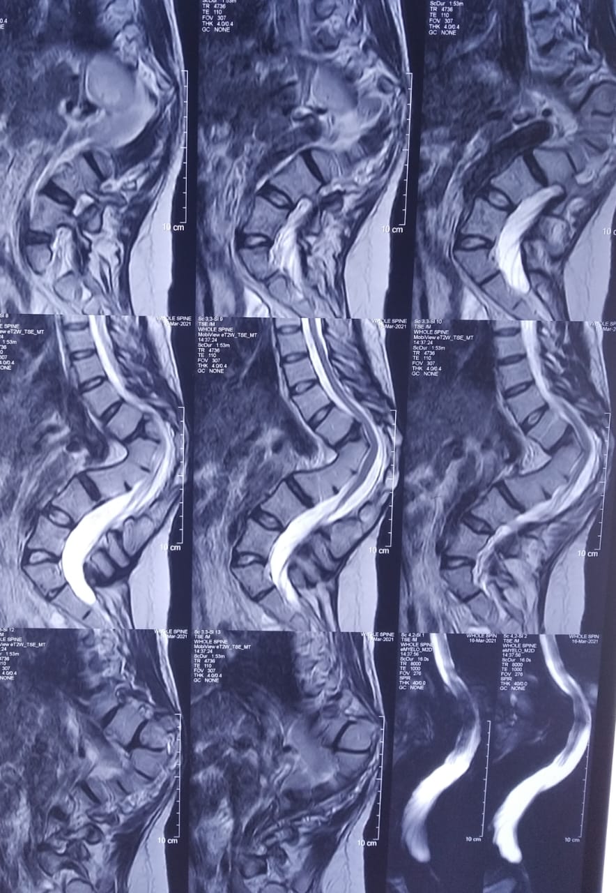Case Study: Correcting Congenital Spine Deformity